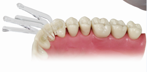 Clip&Splint - Klemmen - Deprophar